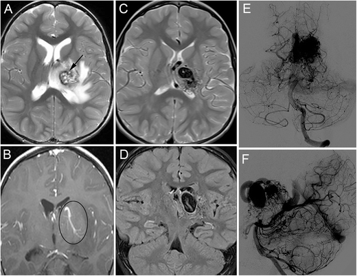 Developmental venous anomaly, capillary telangiectasia, cavernous ...