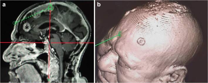Purely endoscopic removal of a parasagittal/falx meningioma | SpringerLink