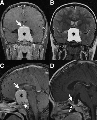 Full endoscopic endonasal transsellar-transclival approach: the ...