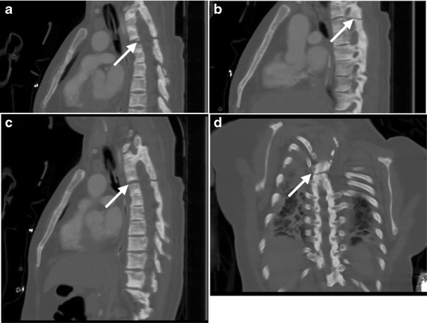 Osteopathia striata with cranial sclerosis (OSCS): review of the ...