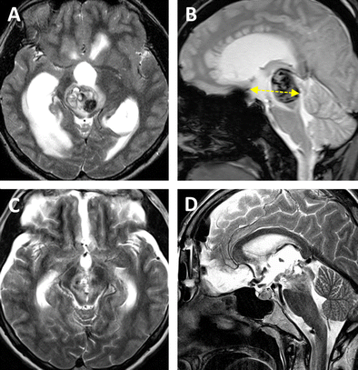 Predicting the necessity of anterior communicating artery division in ...