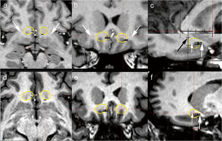 Gamma-knife subcaudate tractotomy for treatment-resistant depression ...
