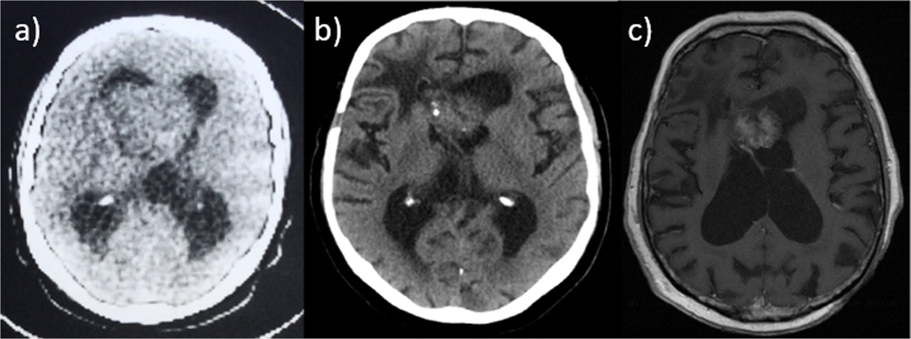 Surgical management and long-term outcome of intracranial subependymoma ...