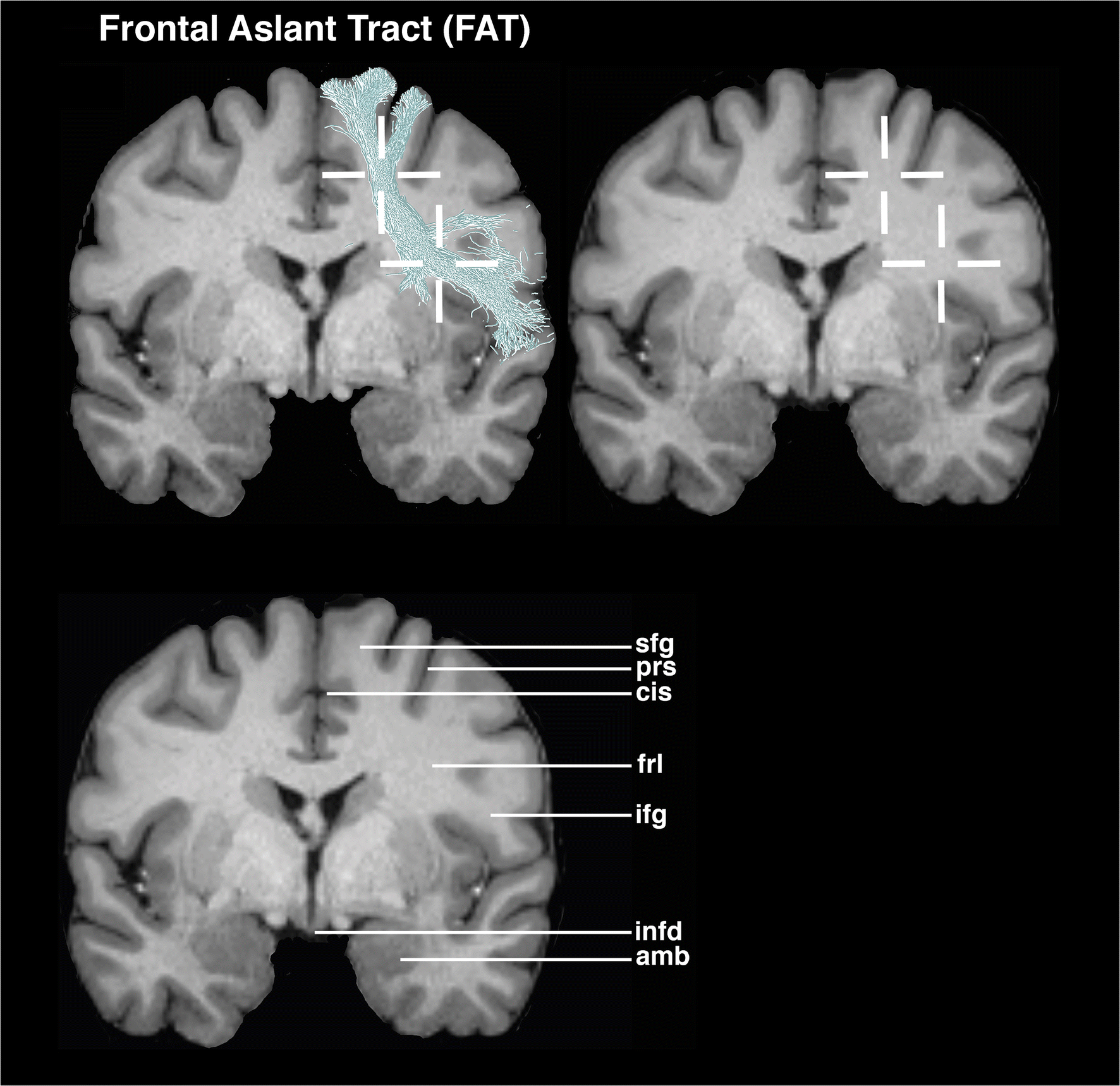 Manual for clinical language tractography | SpringerLink