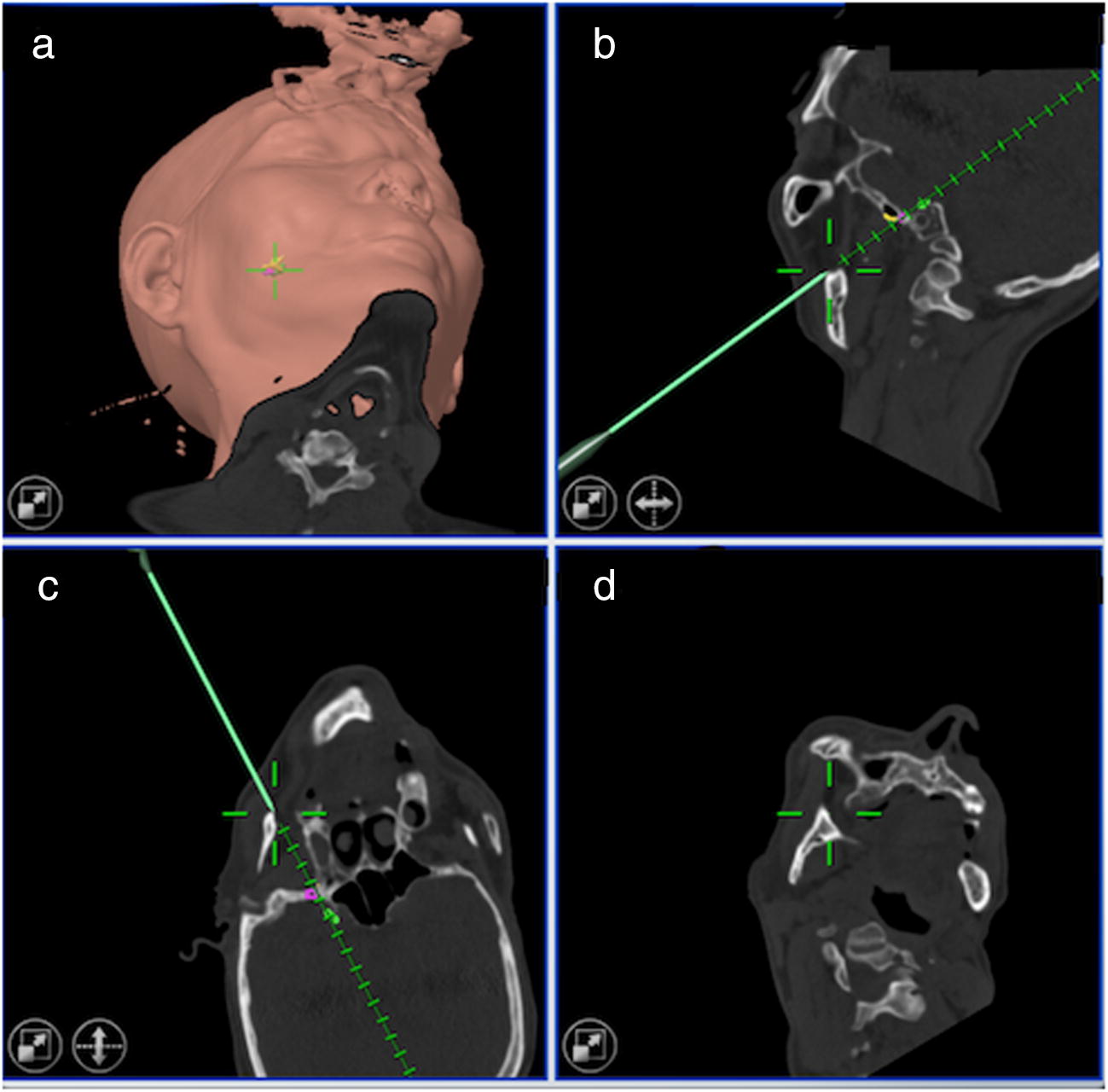 Foramen ovale cannulation guided by intraoperative computed tomography ...