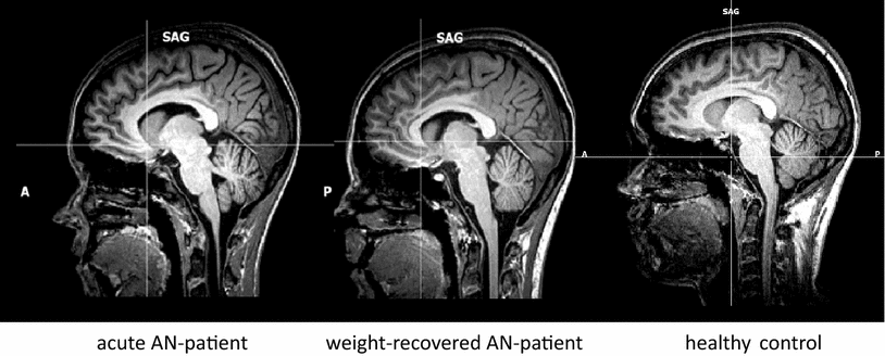 Brain morphological changes in adolescent and adult patients with ...