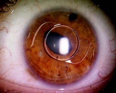 Phakic intraocular lenses: past and present | SpringerLink