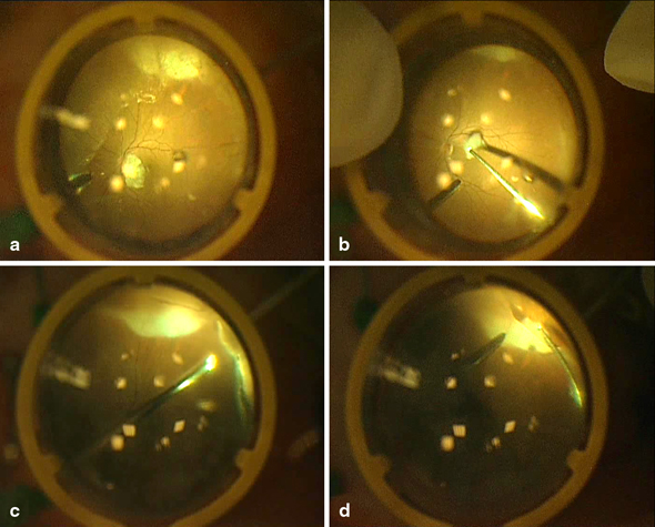 Giant retinal tear complicated with subretinal lens fragment following ...