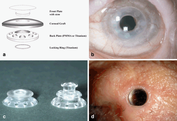 The Boston keratoprosthesis 2014: a step in the evolution of artificial ...