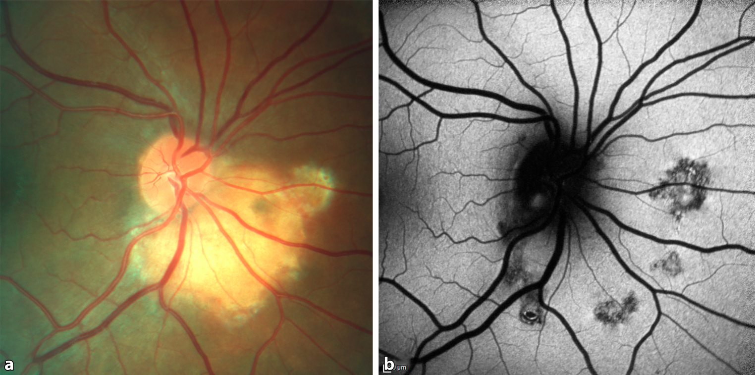 Enhanced depth imaging and swept-source optical coherence tomography ...