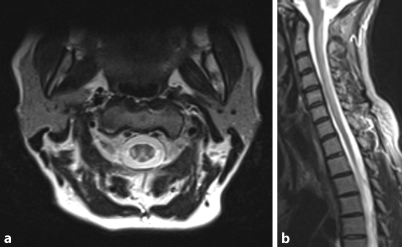 Die funikuläre Myelose in der Differenzialdiagnose T2-hyperintenser ...