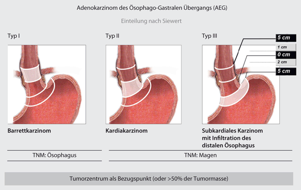 Ösophaguskarzinom | SpringerLink