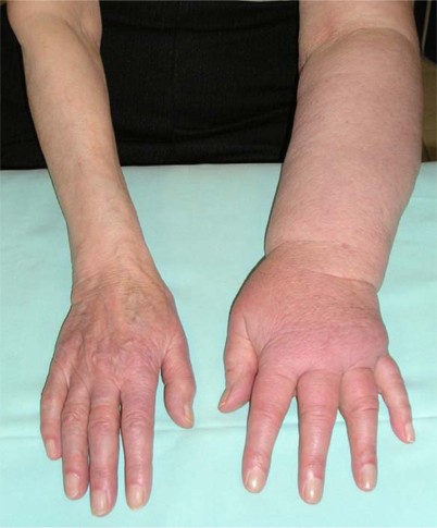 Sekundäres Lymphödem | SpringerLink