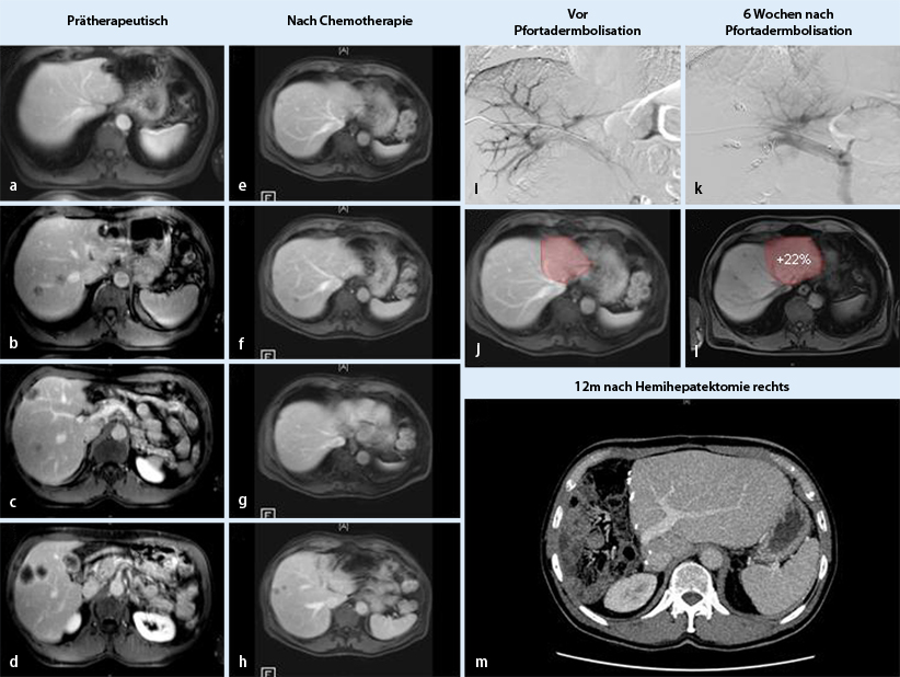 Chirurgische Therapie des Kolonkarzinoms | SpringerLink