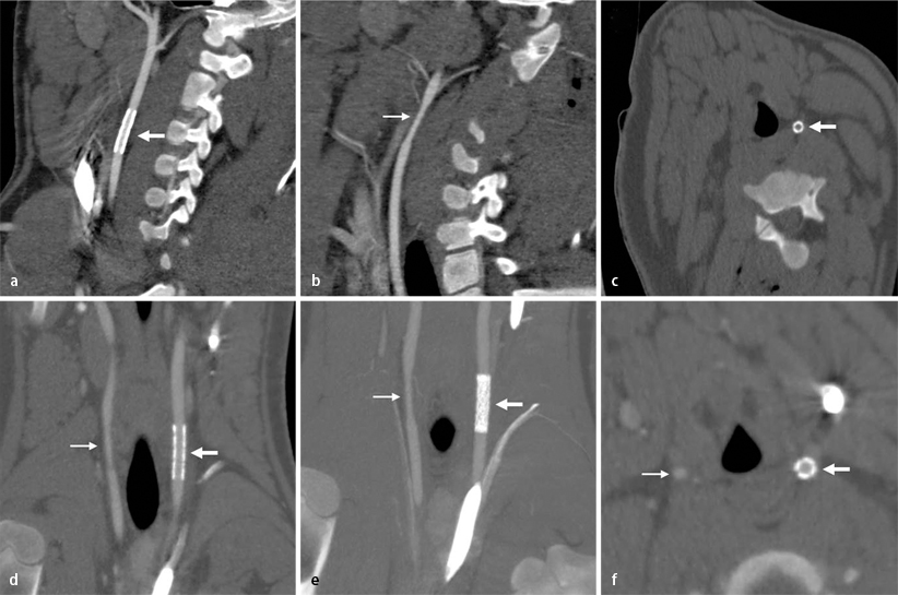 Biodegradable polymeric stents for vascular application in a porcine ...