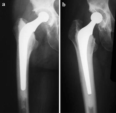 Outcomes of Charnley total hip arthroplasty using improved cementing ...
