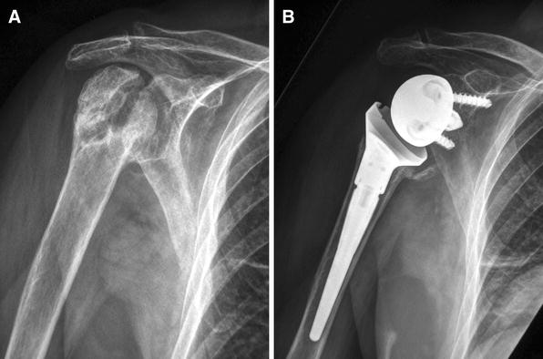 The use of the Lima reverse shoulder arthroplasty for the treatment of ...