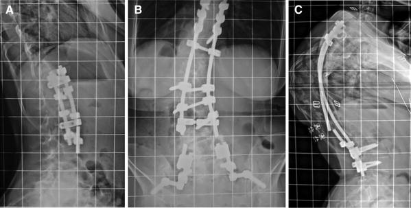 Rod fracture after long construct fusion for spinal deformity: clinical ...