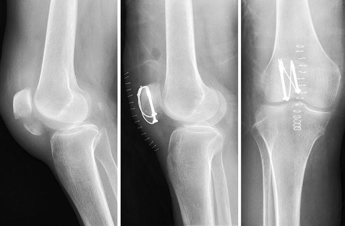Adjustable patella grapple versus cannulated screw and cable technique ...