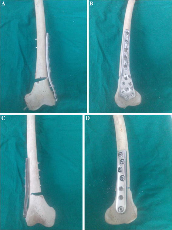Biomechanical analysis of distal femoral fracture fixation: dynamic ...