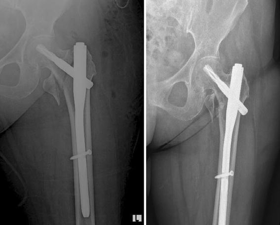 Do PFNA devices and Intertan nails both have the same effects in the ...