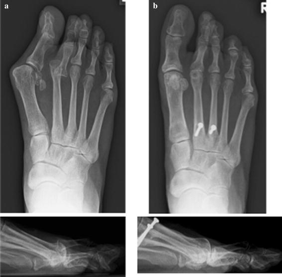 Surgical reduction and ligament reconstruction for chronic dorsal ...