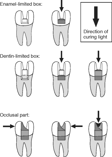 Marginal adaptation of an etch-and-rinse adhesive with a new type of ...