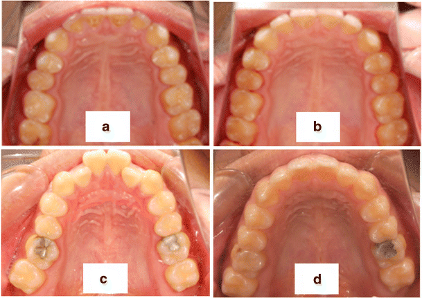 Bone density changes around teeth during orthodontic treatment ...