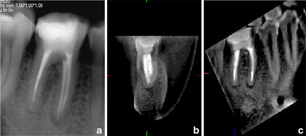 The association between complete absence of post-treatment periapical ...