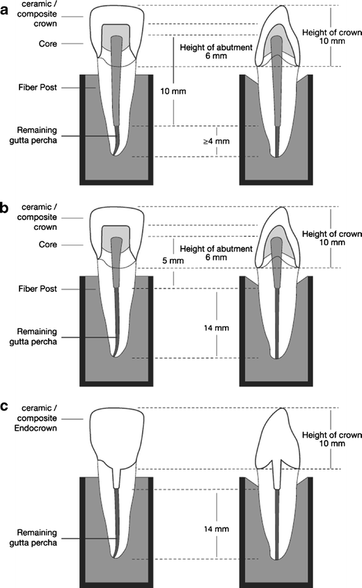 Adhesive restoration of anterior endodontically treated teeth ...