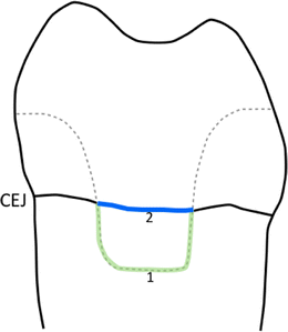Influence of proximal box elevation on the marginal quality and ...