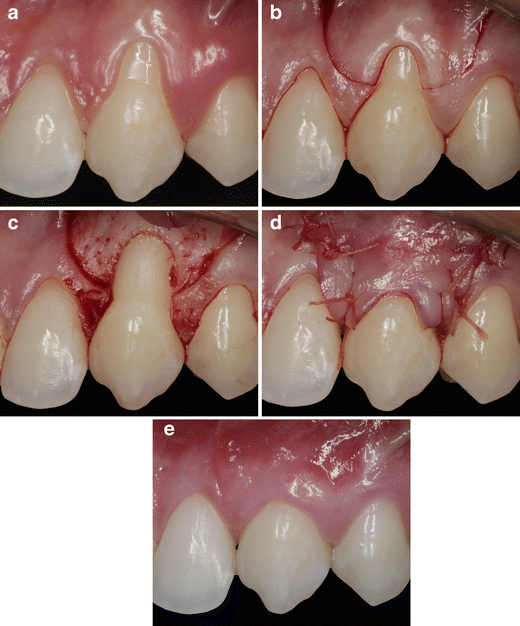 Coronally advanced flap with or without porcine collagen matrix for ...