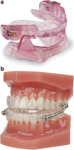 The effectiveness of two types of MADS for OSA therapy | SpringerLink