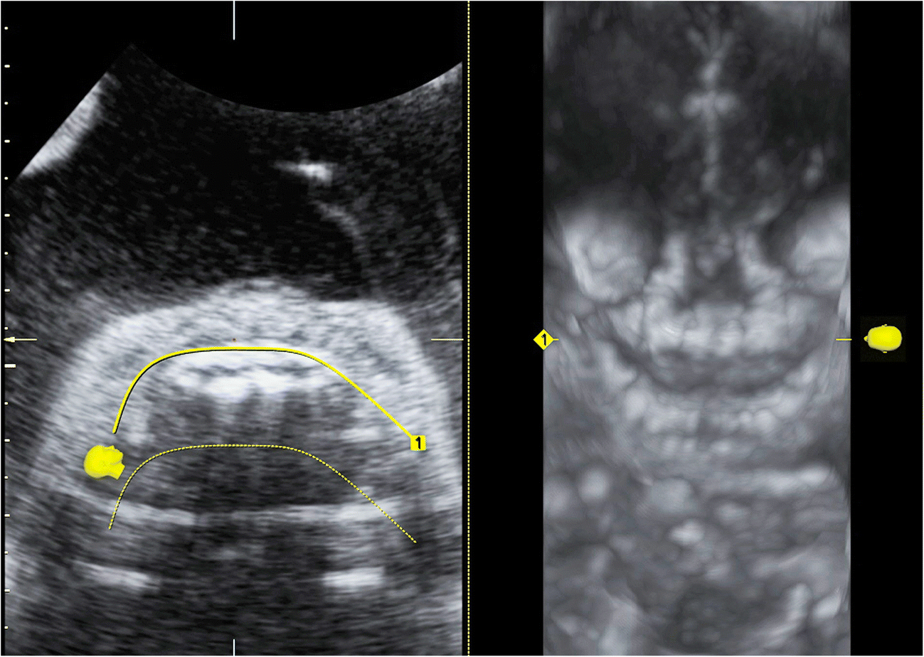 Fetal dental panorama on three-dimensional ultrasound imaging of cleft ...