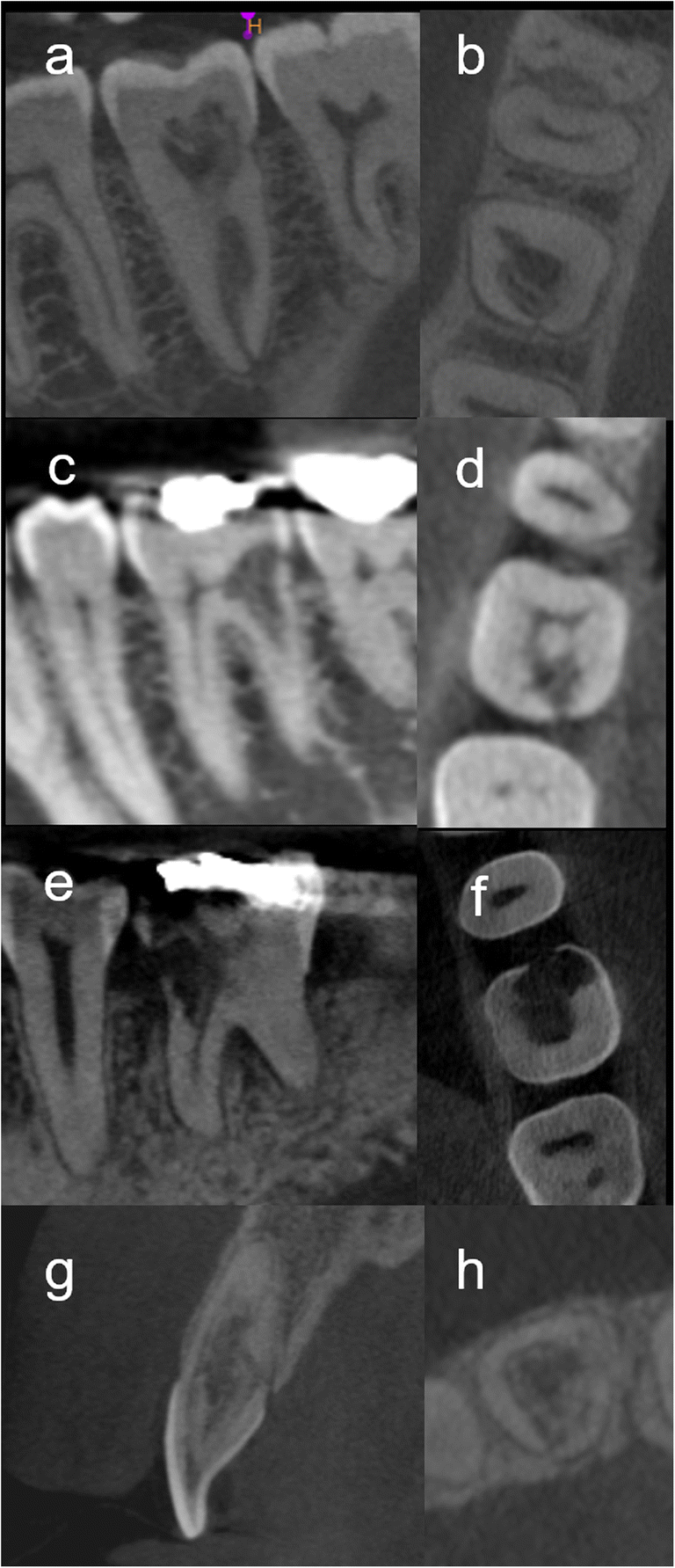 CBCT analyses of advanced cervical resorption aid in selection of ...