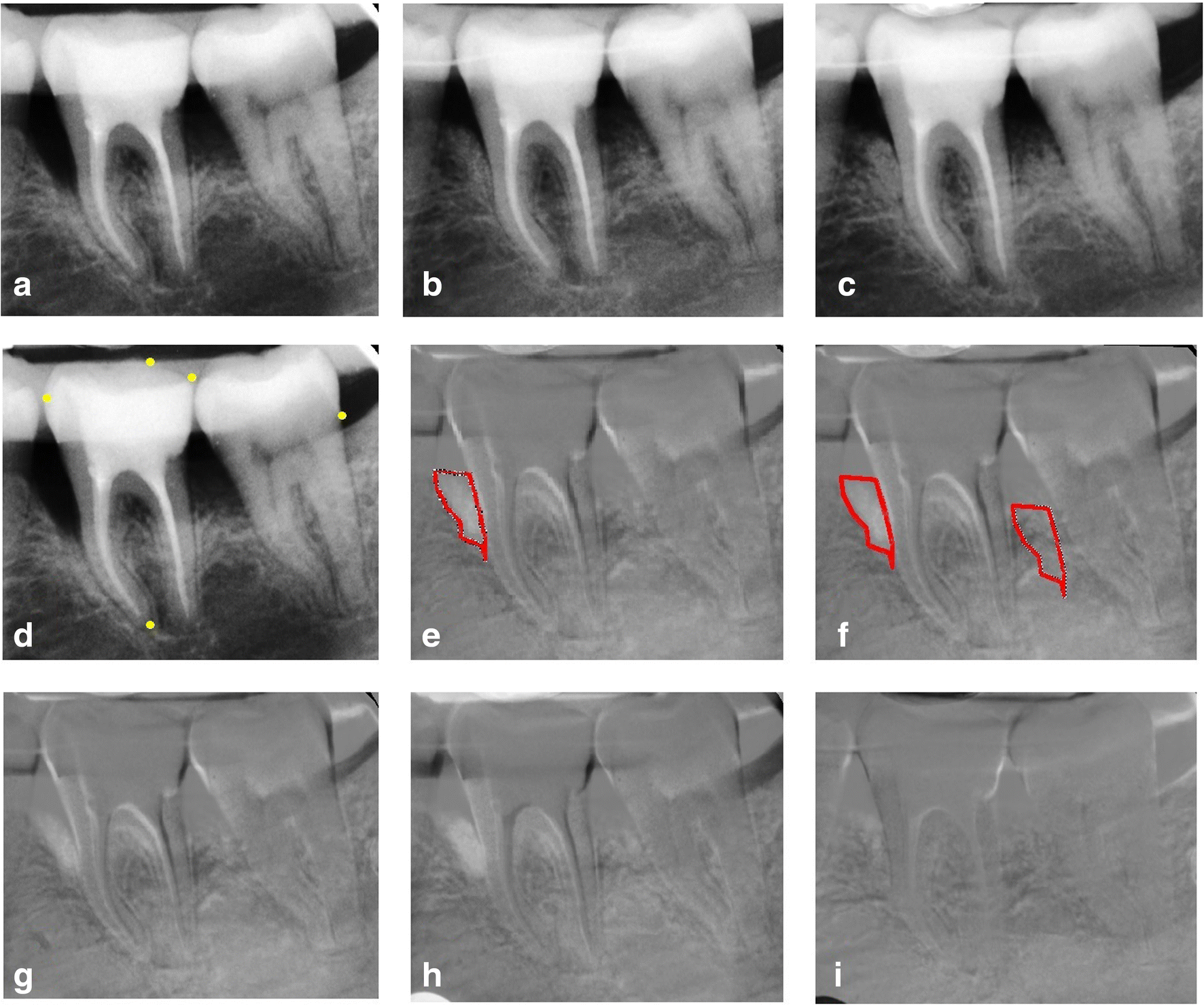 Treatment of intrabony defects with modified perforated membranes in ...