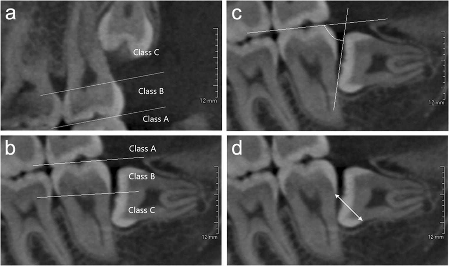 External root resorption in maxillary and mandibular second molars associated with impacted ...