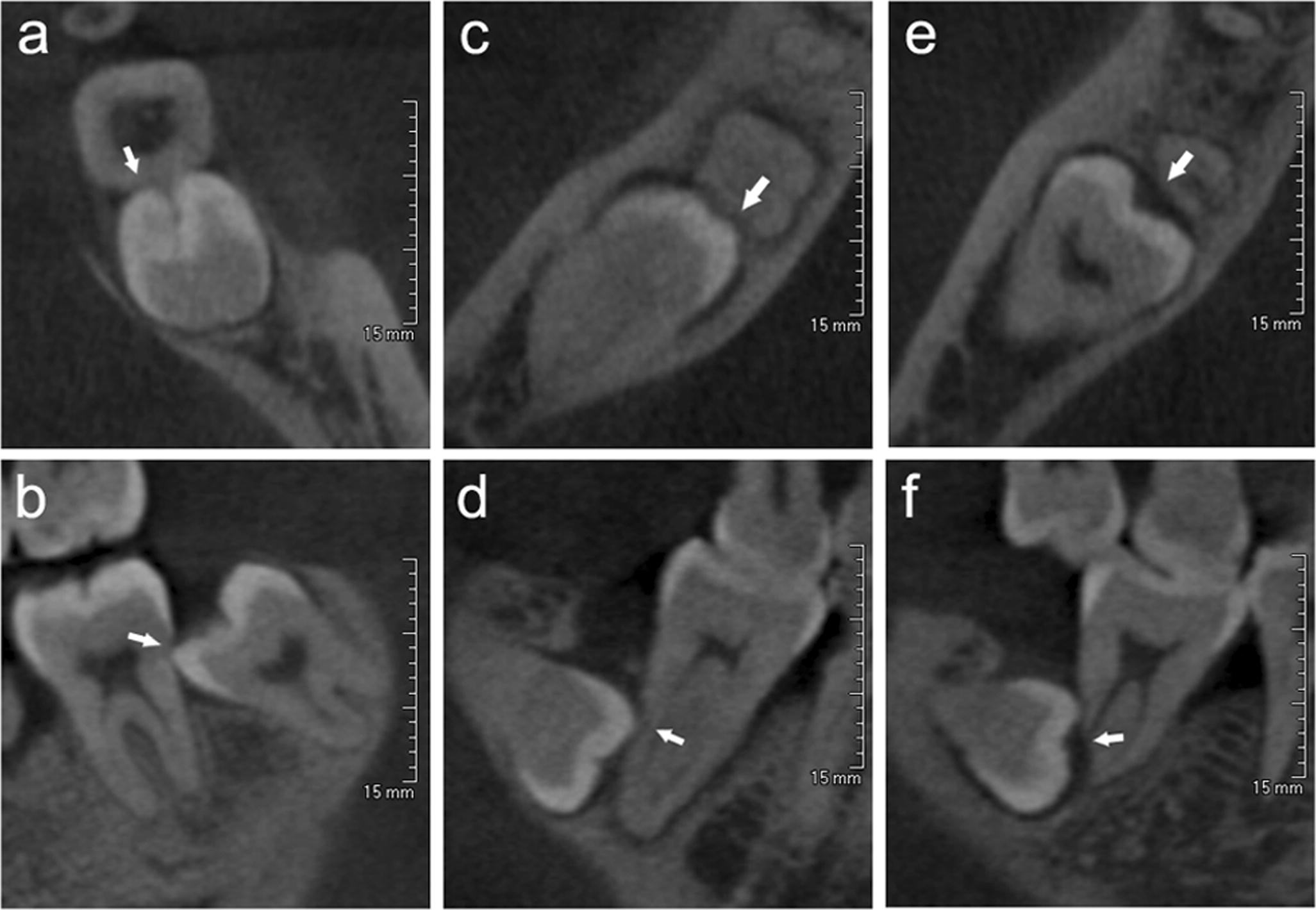 External root resorption in maxillary and mandibular second molars ...