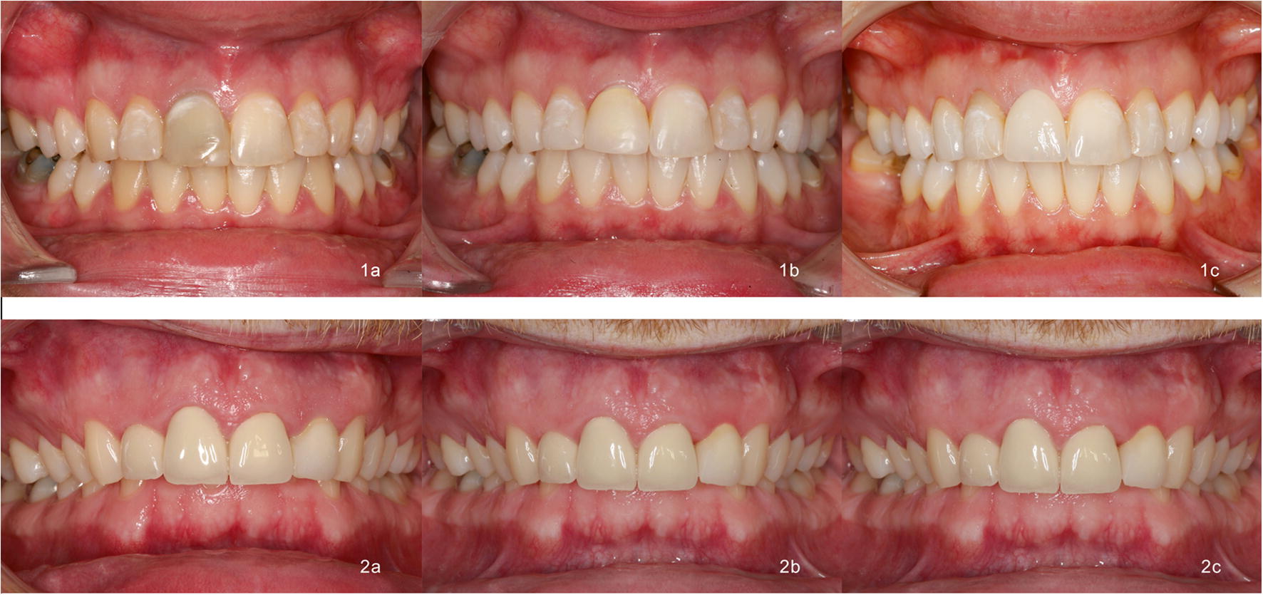 Gingival recession behavior with immediate implant placement in the ...