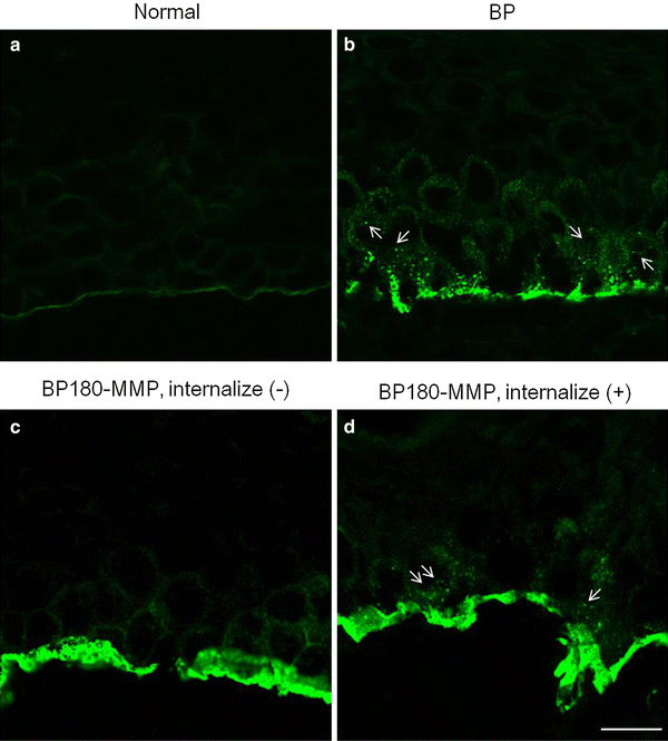 Anti-BP180-type mucous membrane pemphigoid immunoglobulin G shows ...