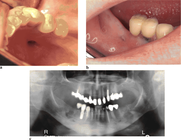 Osteonekrose der Kiefer unter Bisphosphonat-Langzeittherapie | SpringerLink