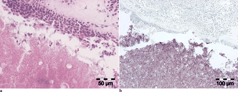 Allergische Pilzsinusitis, Fungusball und invasive Mykose der ...