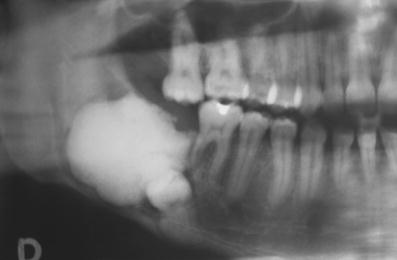 Two-stage surgical removal of large complex odontoma | SpringerLink