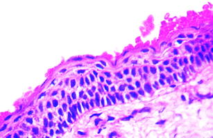 Keratocystic odontogenic tumour (KCOT)—a cyst to a tumour | SpringerLink