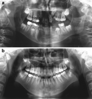 Management of central giant cell granuloma of the jaws with ...