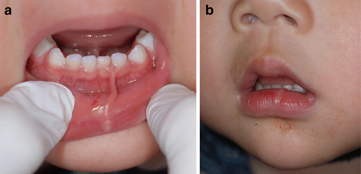 Frenum-like oral synechiae of the lip and vestibule | SpringerLink