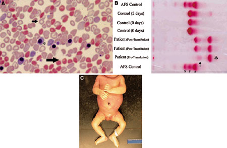 Alpha-Thalassemia Major Presenting in a Term Neonate without Hydrops ...