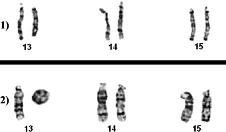 Genetic Haploinsufficiency as a Phenotypic Determinant of a Deletion ...