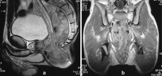 Secondary perineal hernia following open abdominoperineal excision of ...