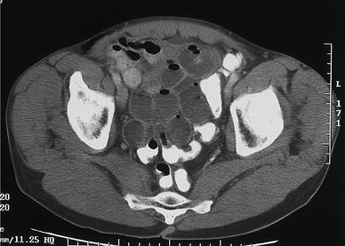 Preperitoneal herniation and bowel obstruction post laparoscopic ...